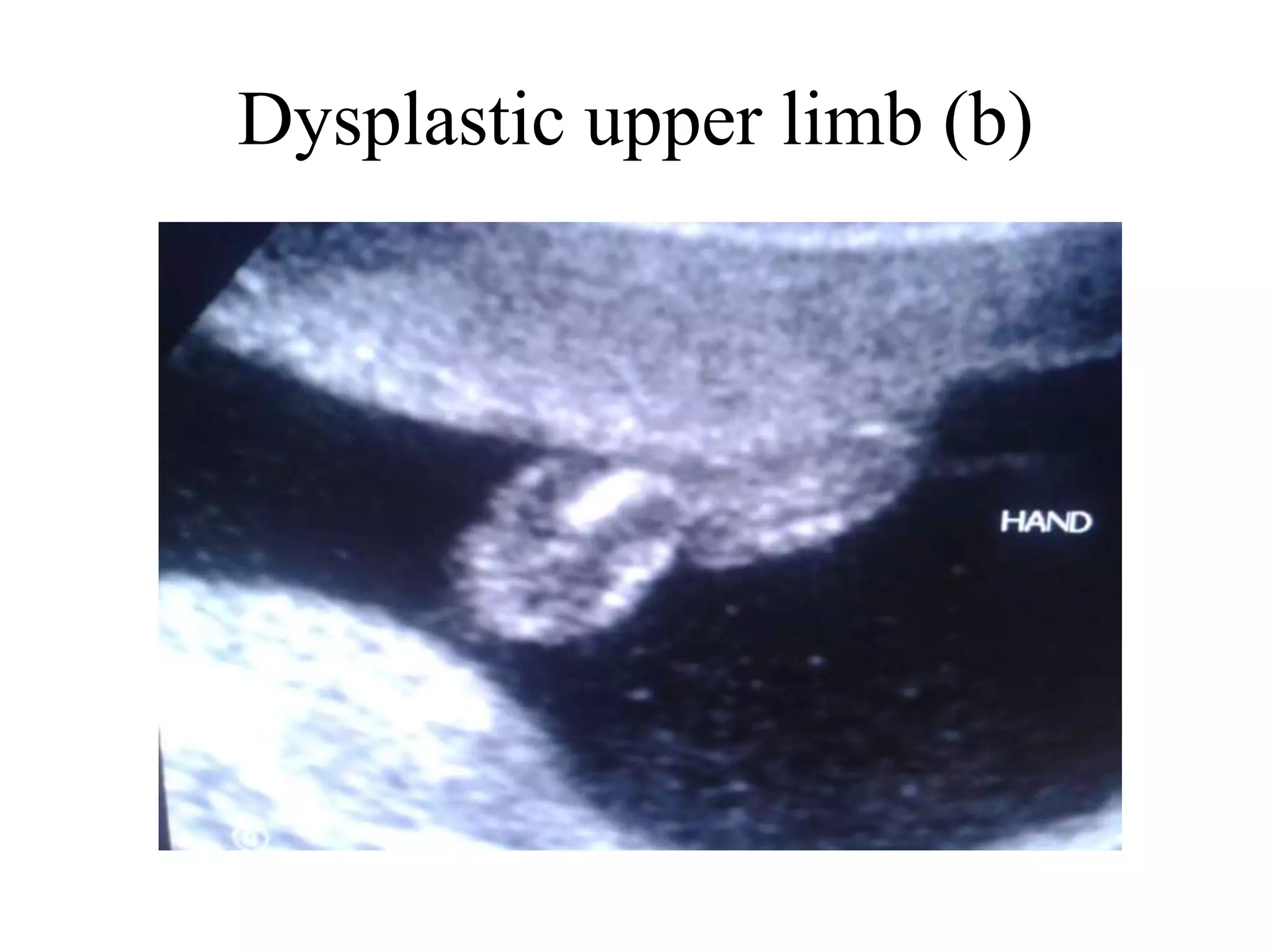 By dr. vijay sharma asphyxiating thoracic dysplasia (jeune syndrome ...