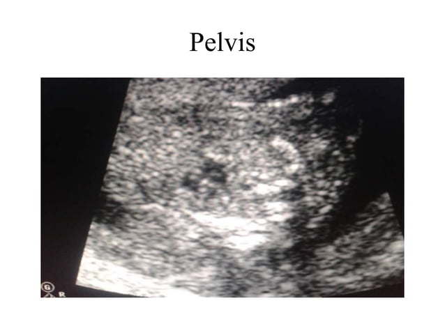 By dr. vijay sharma asphyxiating thoracic dysplasia (jeune syndrome ...