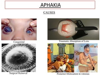 By pd aphakia & pseudophakia | PPTX