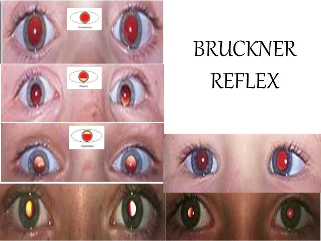 By pd examination of a squint