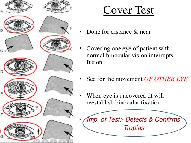 By pd examination of a squint