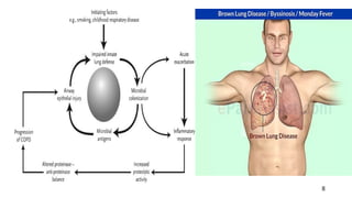 BYSSINOSIS.Anvesh.pptx,,,,,,............. | PPTX