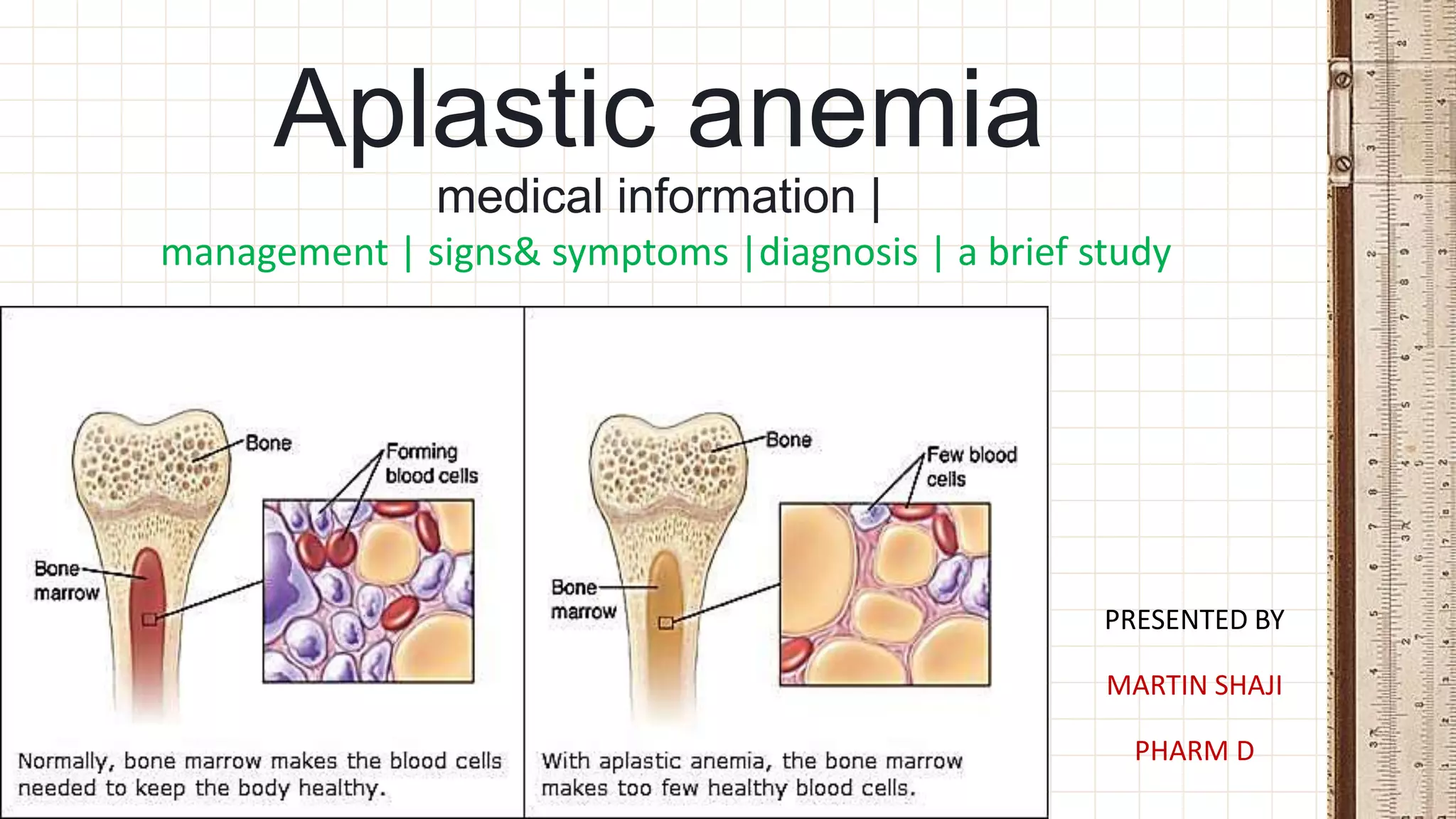 Aplastic anemia -medical information (definition,management, diagnosis, medical aspects ) | PPTX