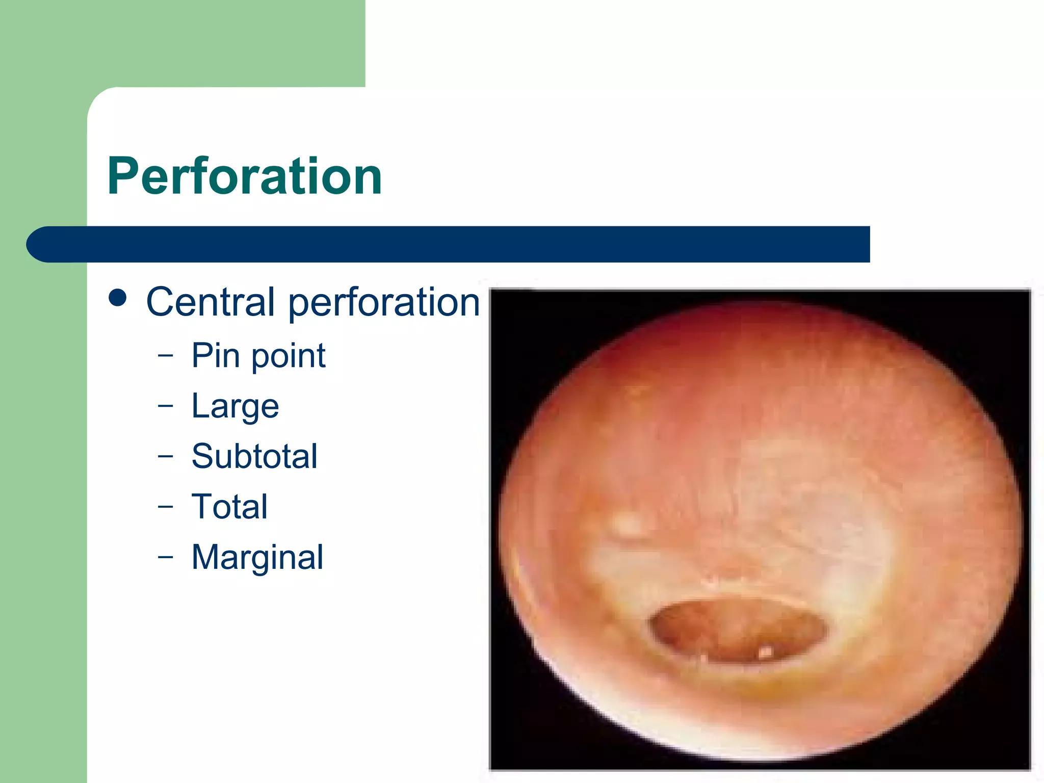 Chronic suppurative otitis media | PPT