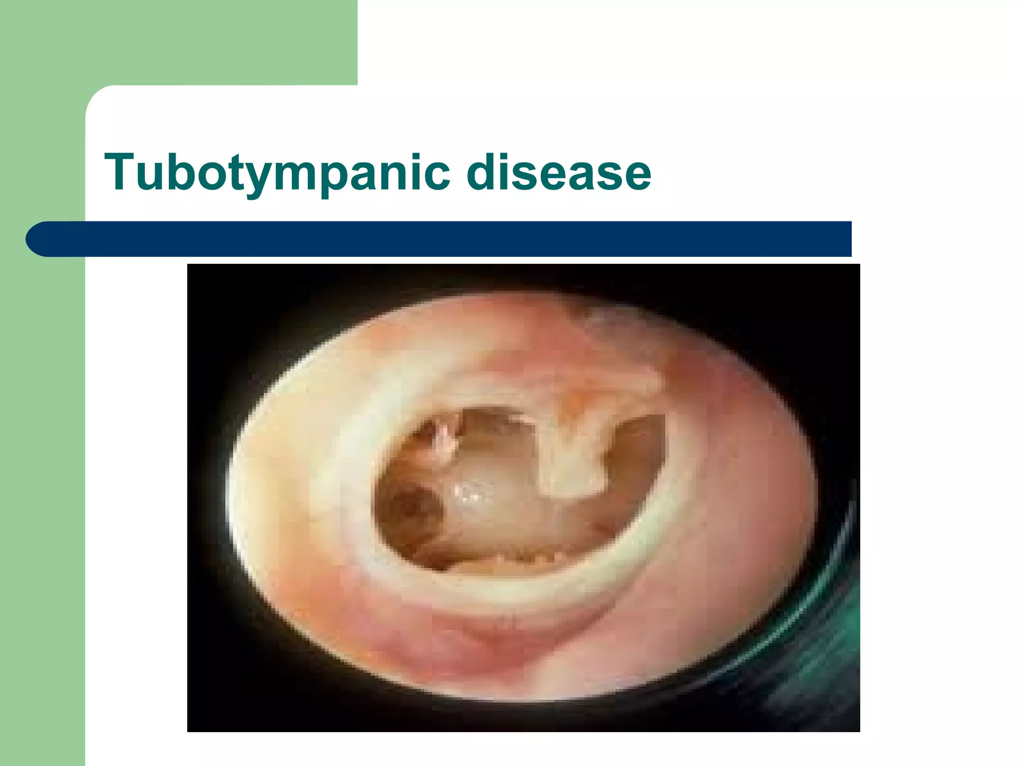 Chronic suppurative otitis media | PPT