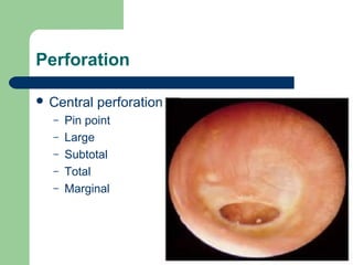 Chronic suppurative otitis media | PPT