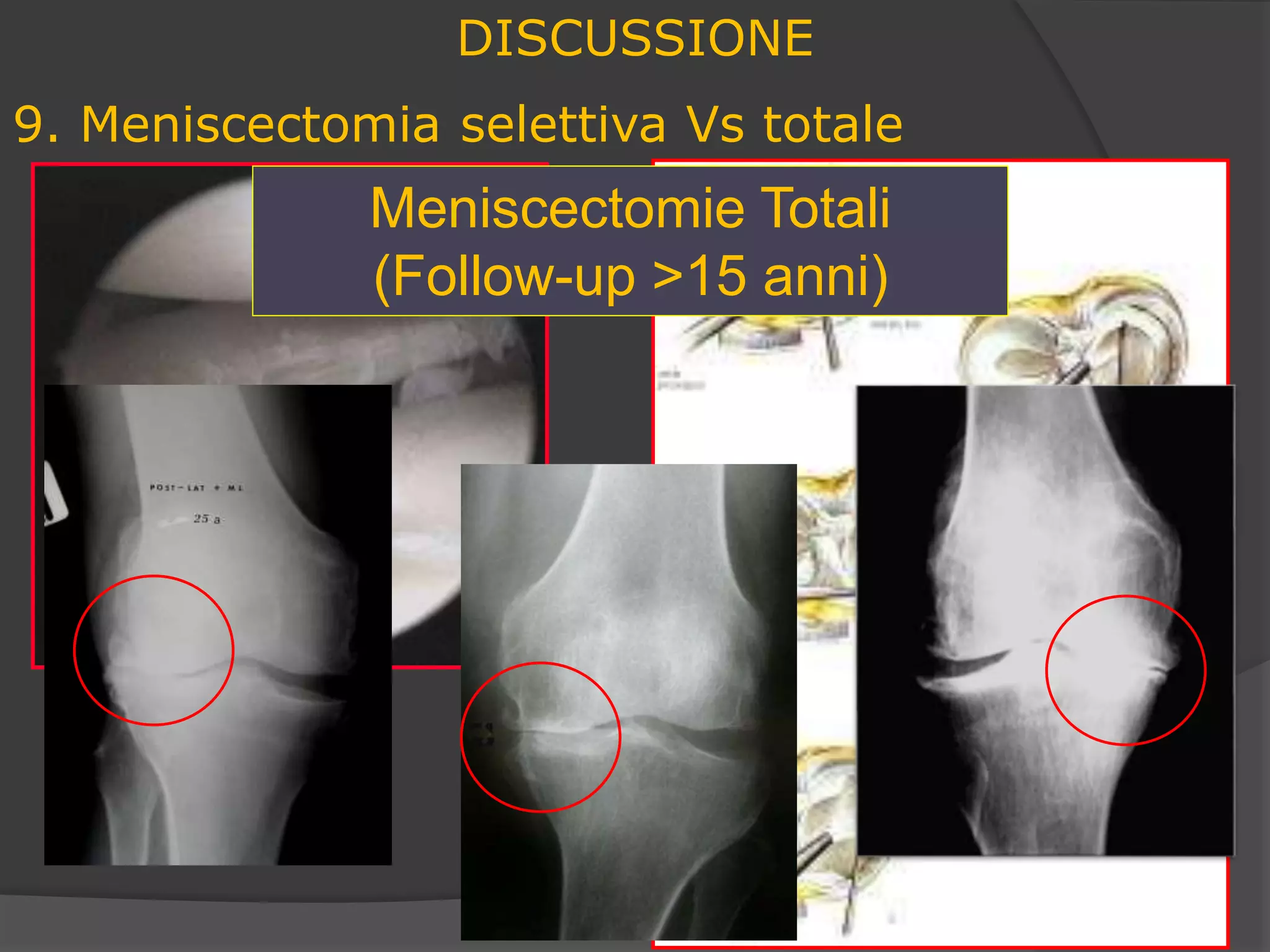 Caso clinico di lesione meniscale | PPT