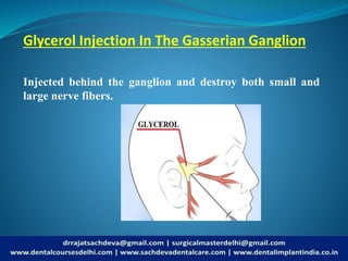 Trigeminal Neuralgia| Management of Facial Pain | PPT