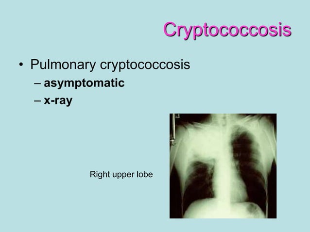 Cryptococcosis | PPT | Infectious Diseases | Diseases and Conditions