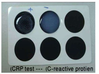 C-reactive protein (CRP) is a protein made by the liver | PPTX