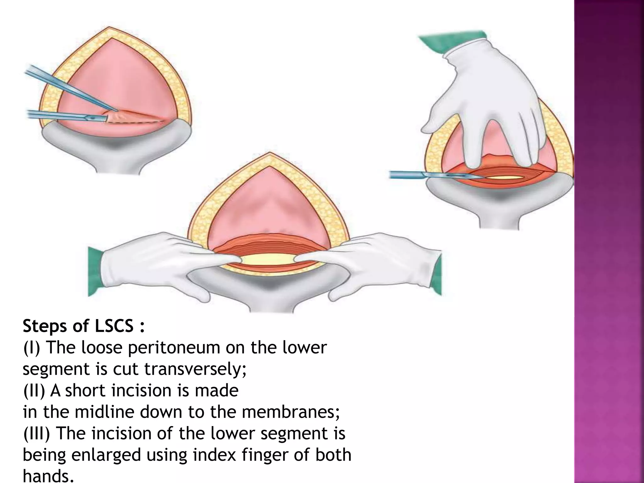 Cesarean Section Ppt