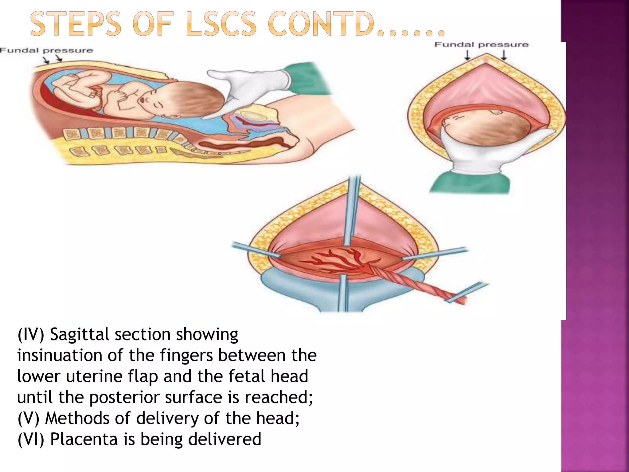 cesarean section | PPTX