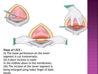 cesarean section | PPTX