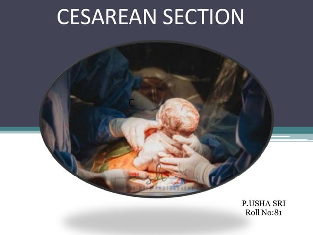 C - section complications | PPTX