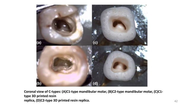 C- SHAPED CANALS pptx by DR. AMAL DEVADAS | PPTX