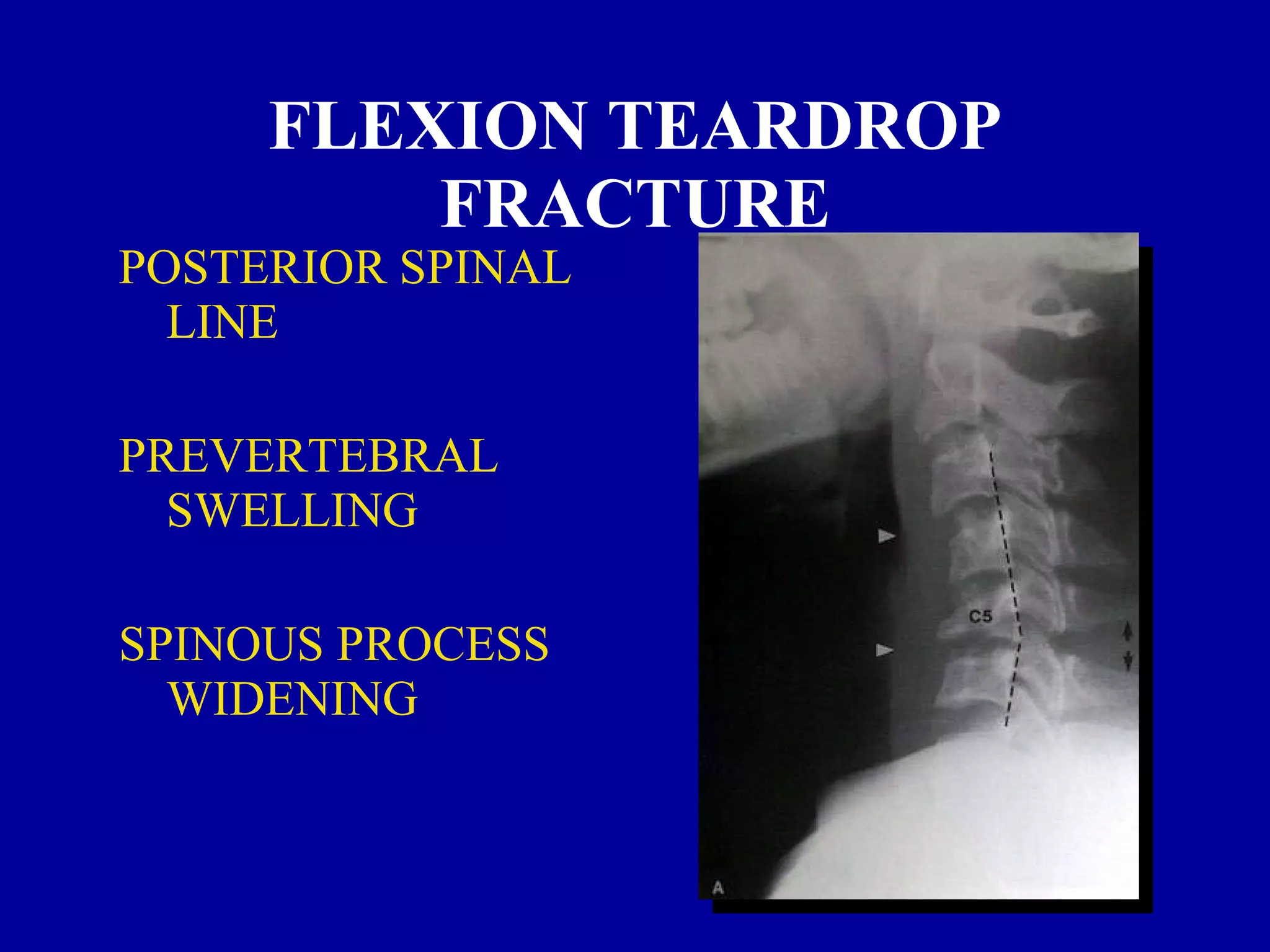 Cervical Spine Injury | C Spine | Clearing the Cervical Spine | PPT
