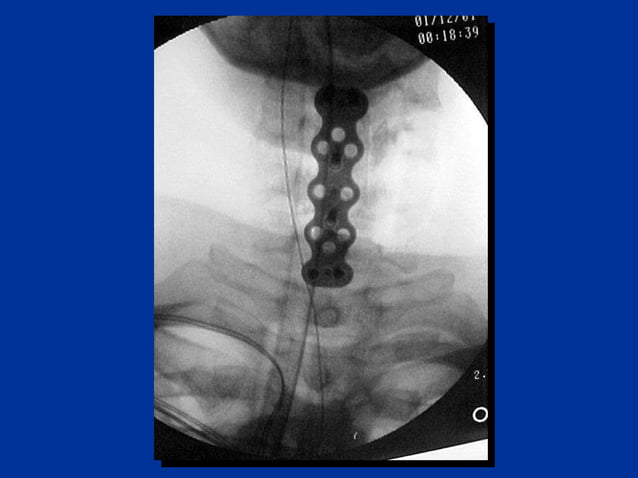 Cervical Spine Injury | C Spine | Clearing the Cervical Spine | PPT