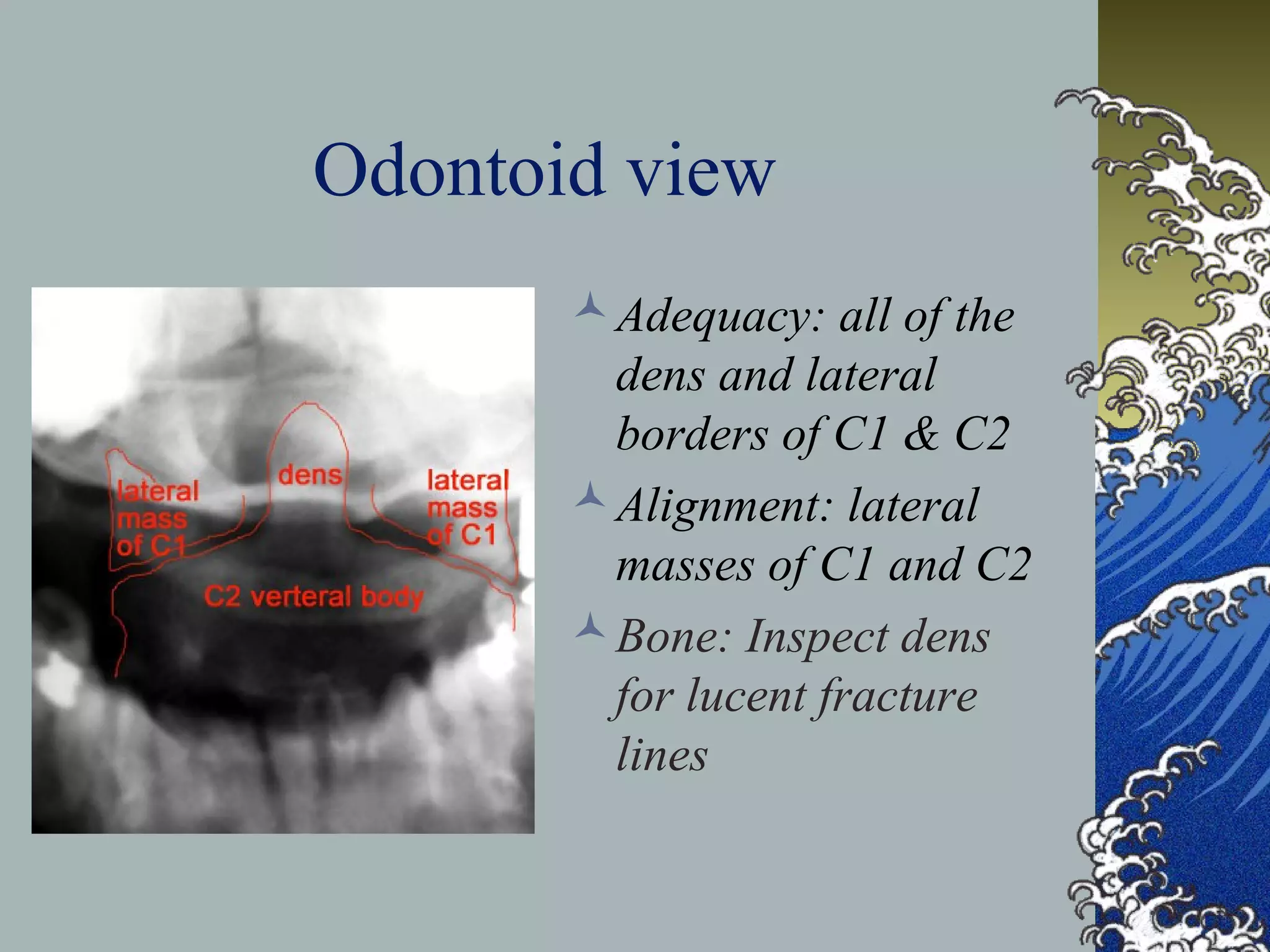 C spine fractures final | PPT