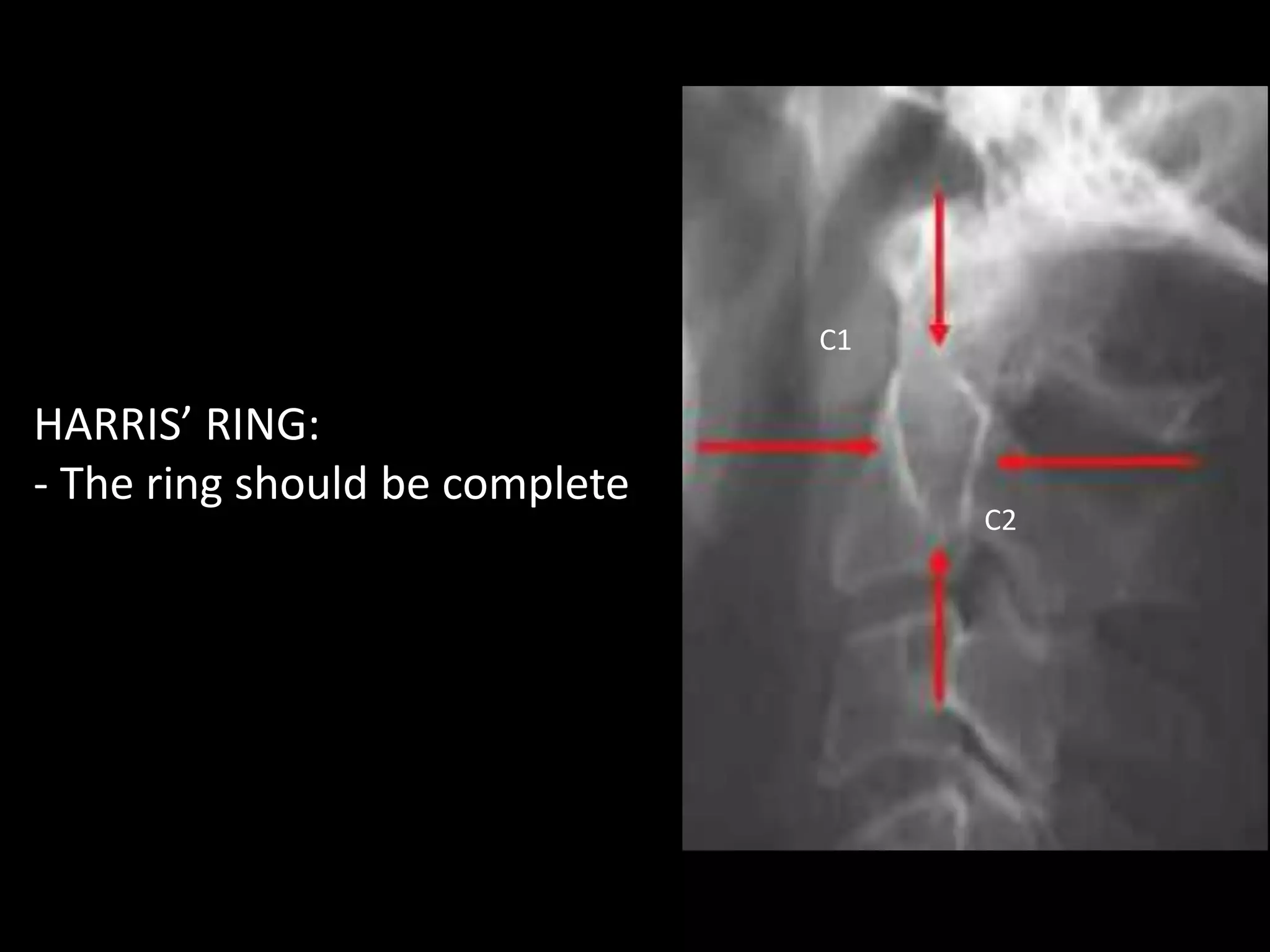 Cervical Spine Trauma Imaging | PPTX