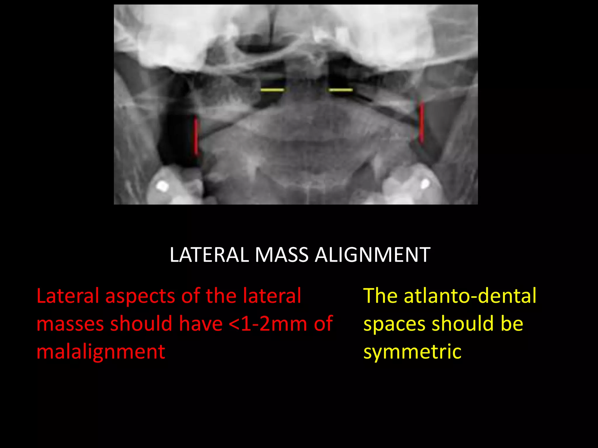Cervical Spine Trauma Imaging | PPTX