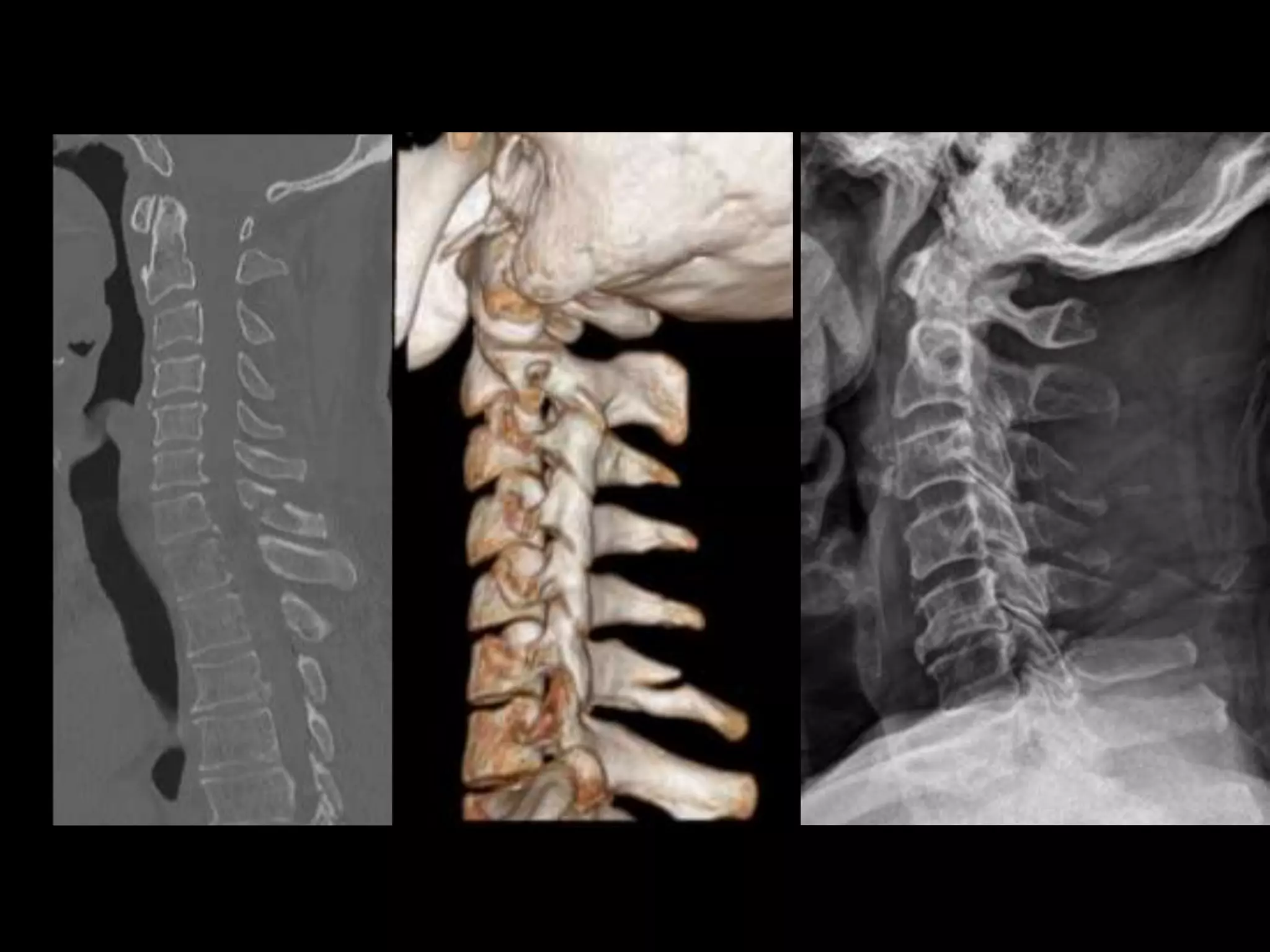 Cervical Spine Trauma Imaging | PPTX