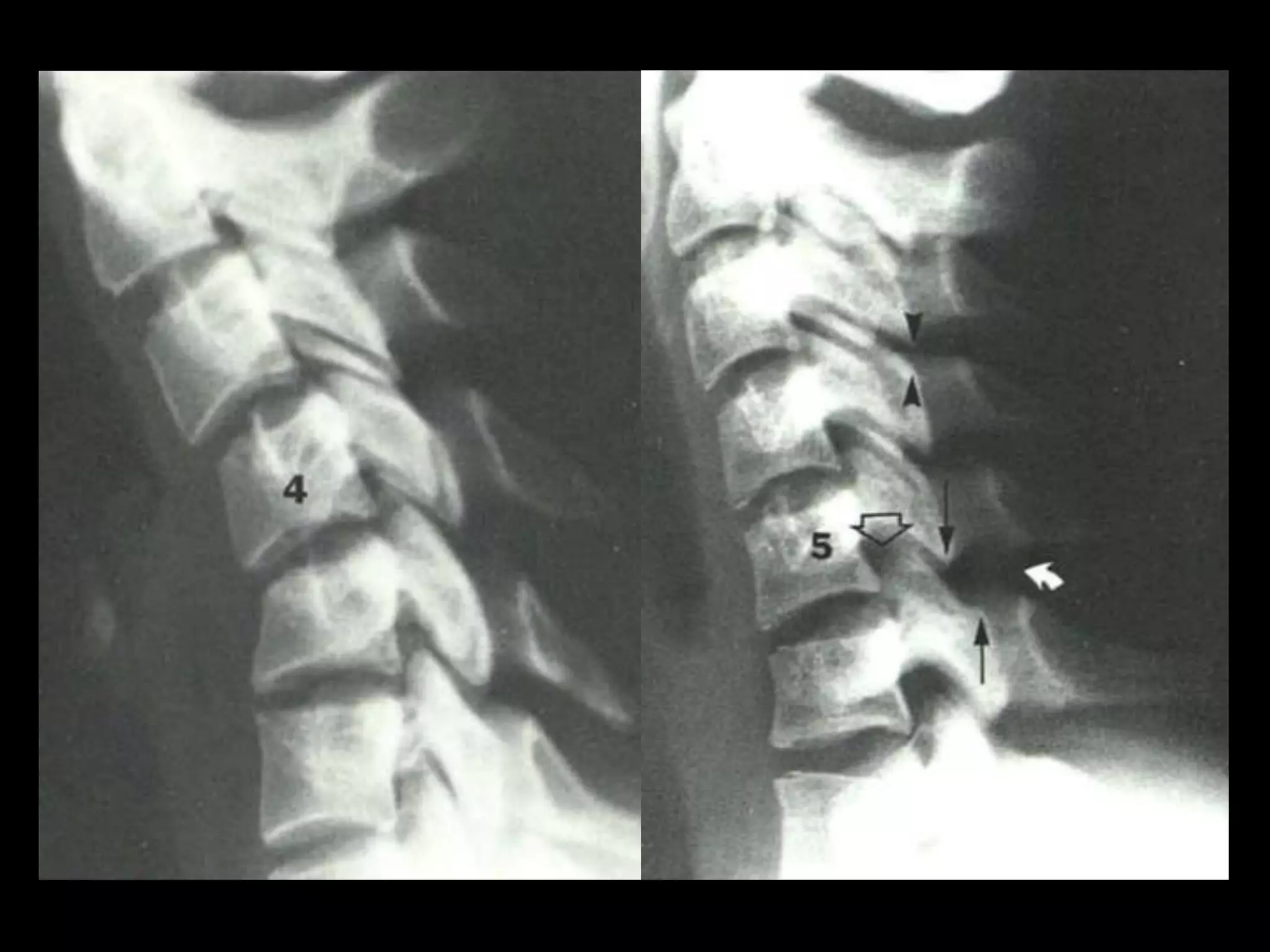 Cervical Spine Trauma Imaging | PPTX
