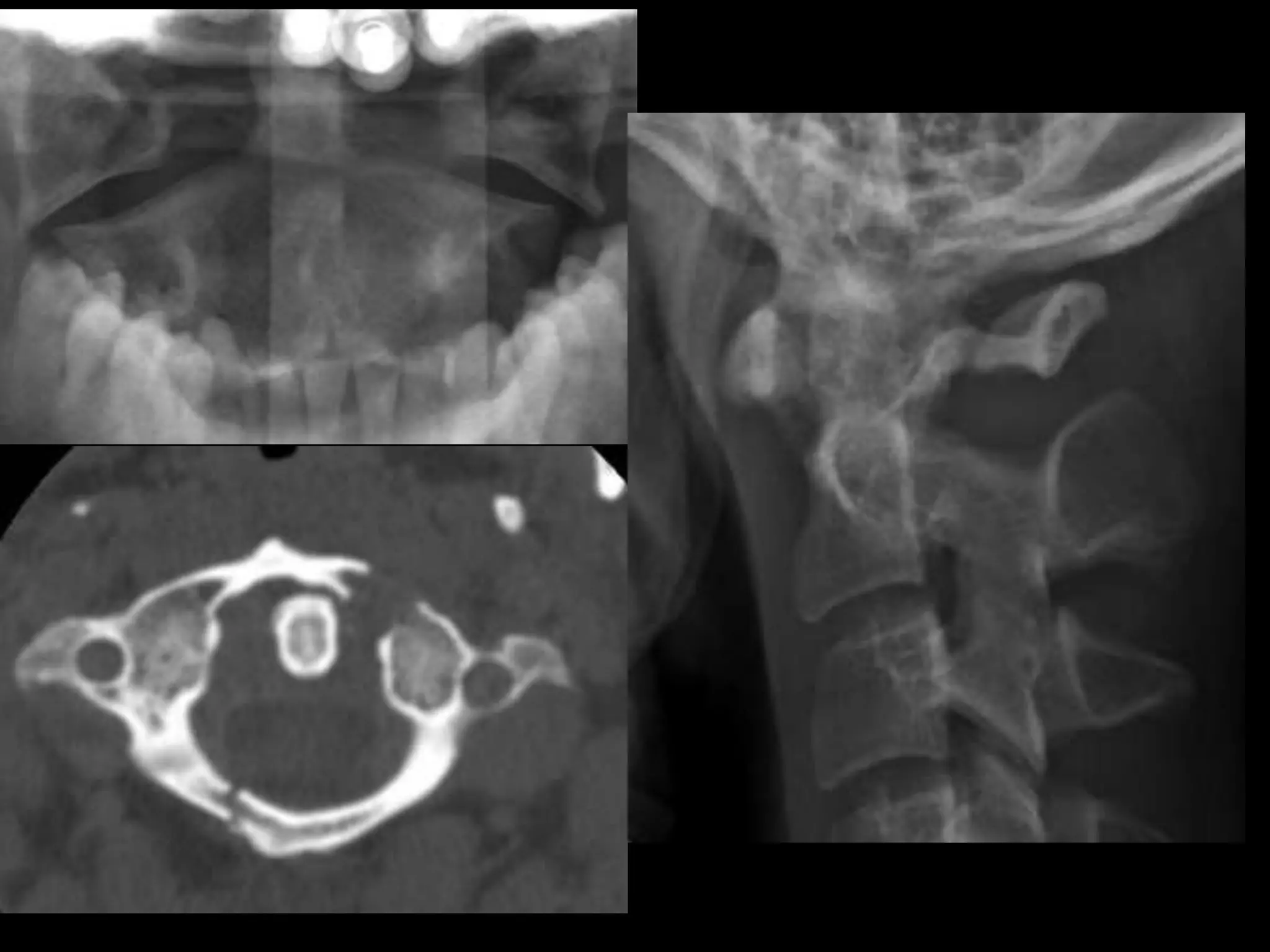 Cervical Spine Trauma Imaging | PPTX