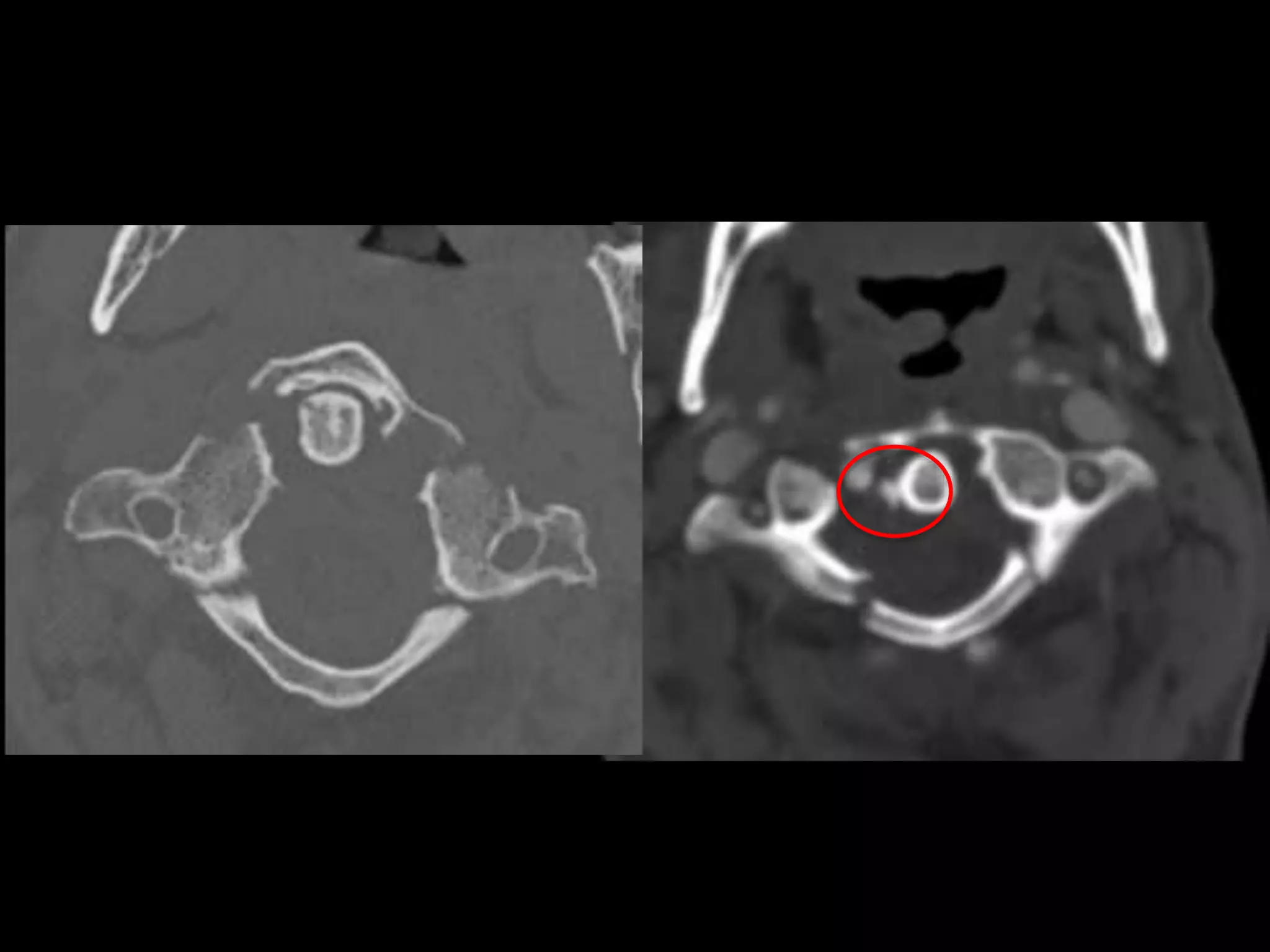 Cervical Spine Trauma Imaging | PPTX