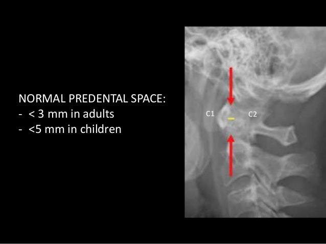 Cervical Spine Trauma Imaging