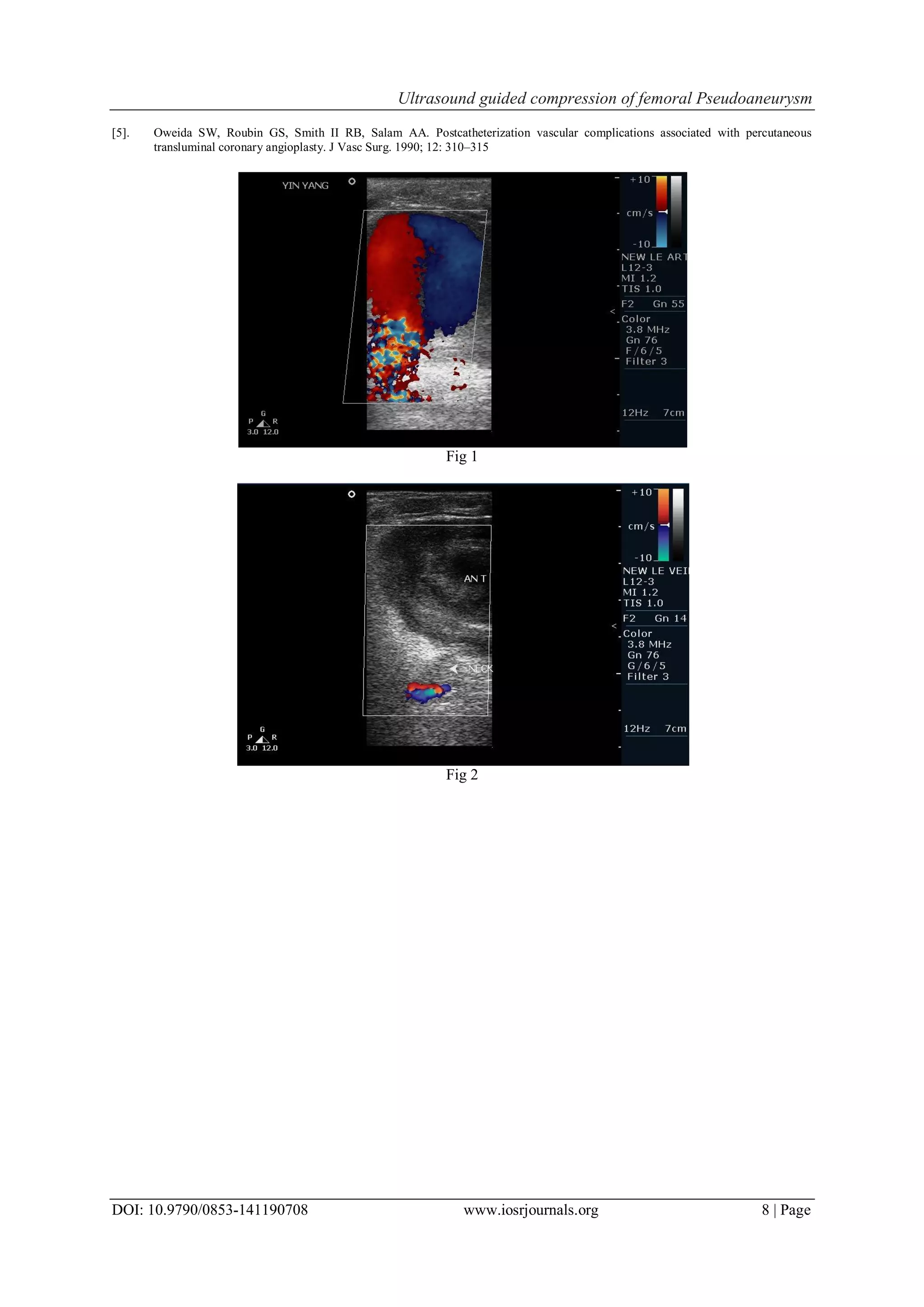 Ultrasound guided compression of femoral Pseudoaneurysm | PDF