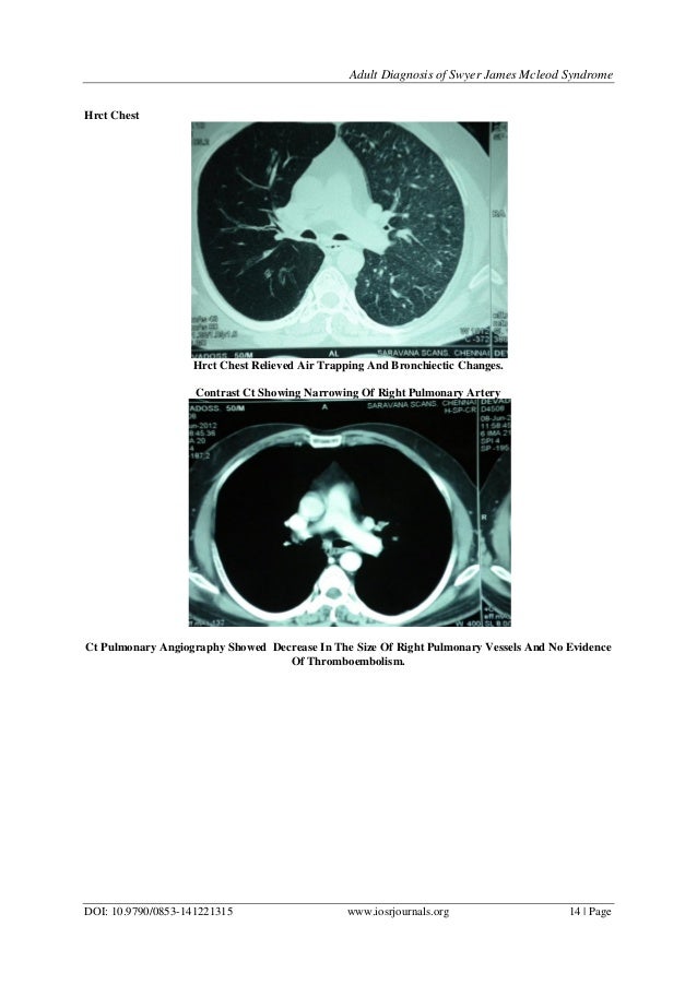 Adult Diagnosis Of Swyer James Mcleod Syndrome