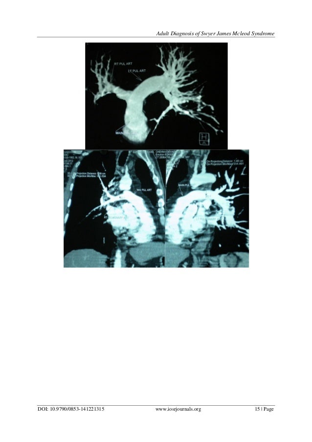 Adult Diagnosis Of Swyer James Mcleod Syndrome