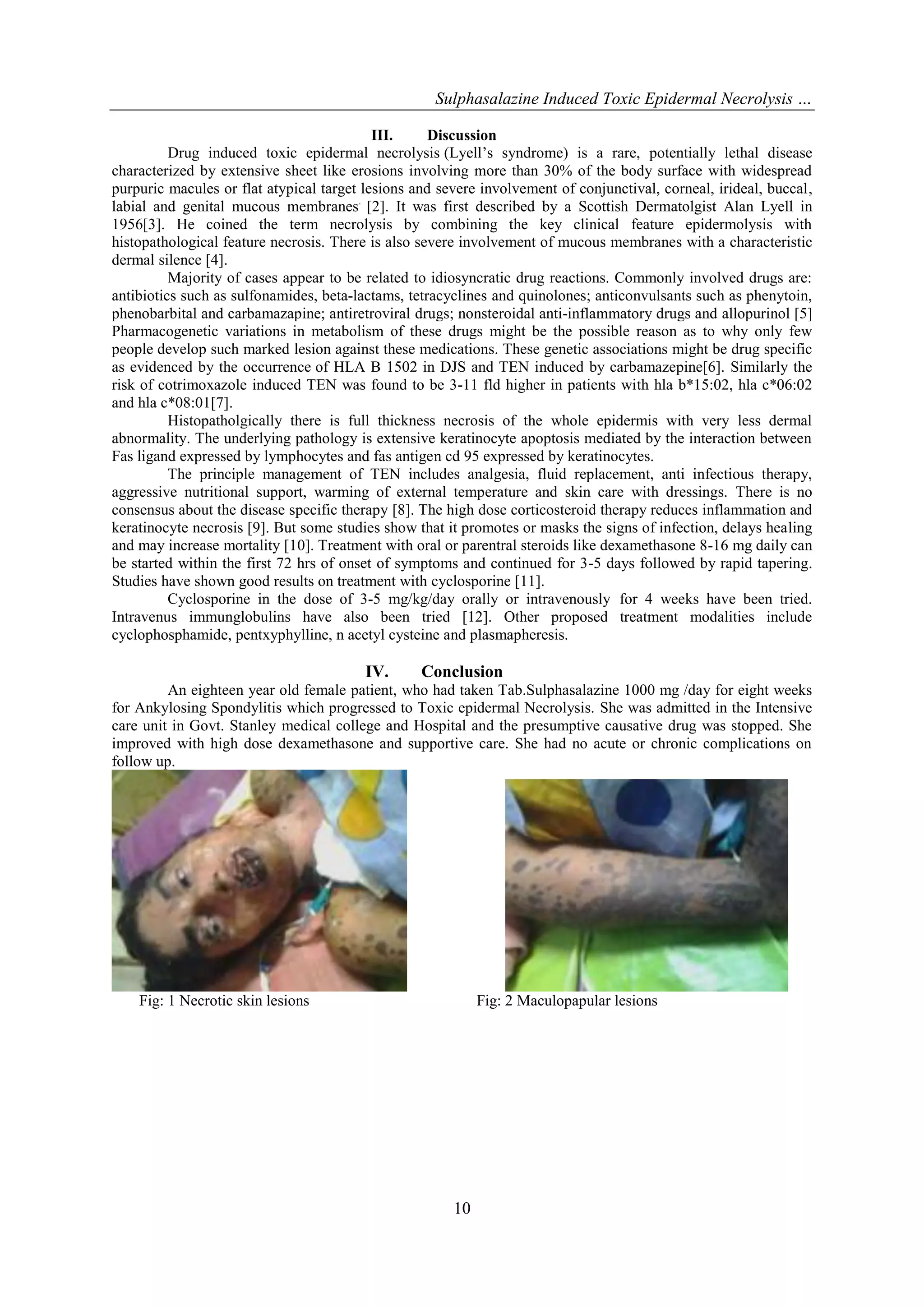 Sulphasalazine Induced Toxic Epidermal Necrolysis A Case Report | PDF