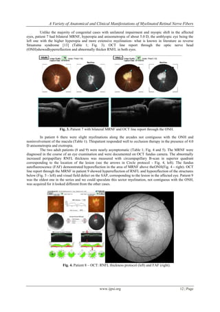 A Variety of Anatomical and Clinical Manifestations of Myelinated ...