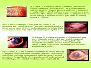 C09 P01 TRACHOMA.presentatuonnsnnsmamkabsn | PPT