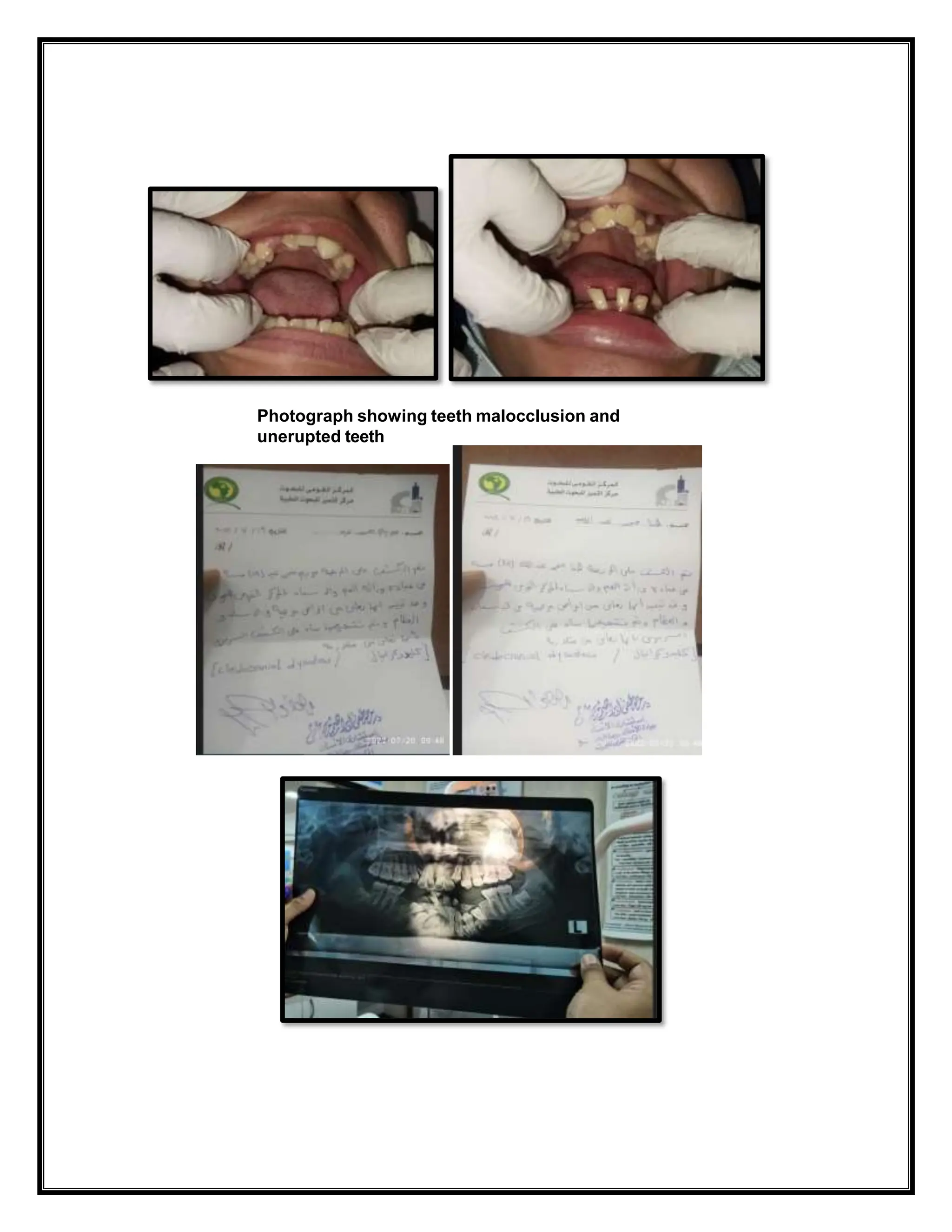 Cleidocranial Dysplasia (Dysostosis).pptx