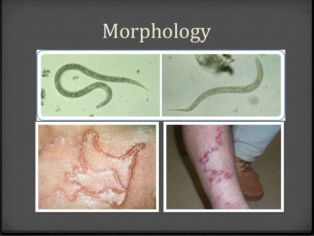 Hookworm Larva Migrans Presentation