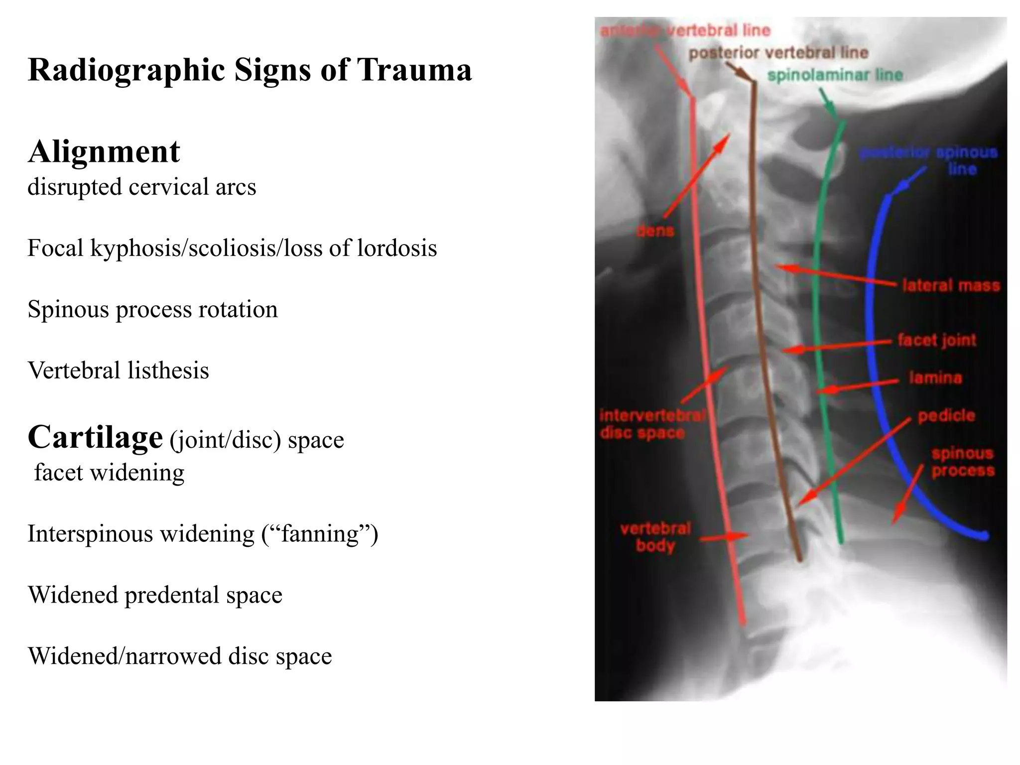 C1 C2 fractures | PPTX