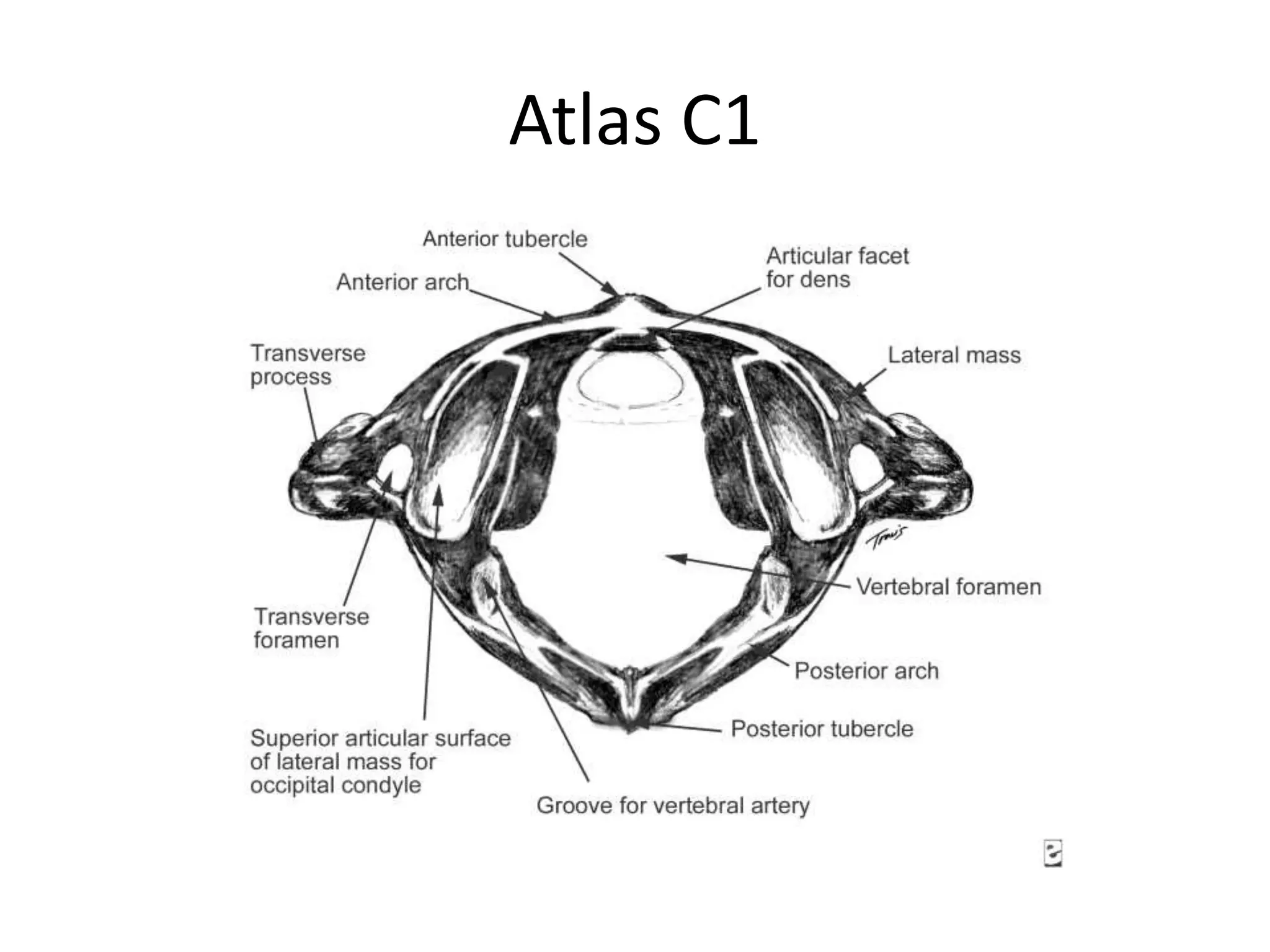 C1 C2 fractures | PPTX