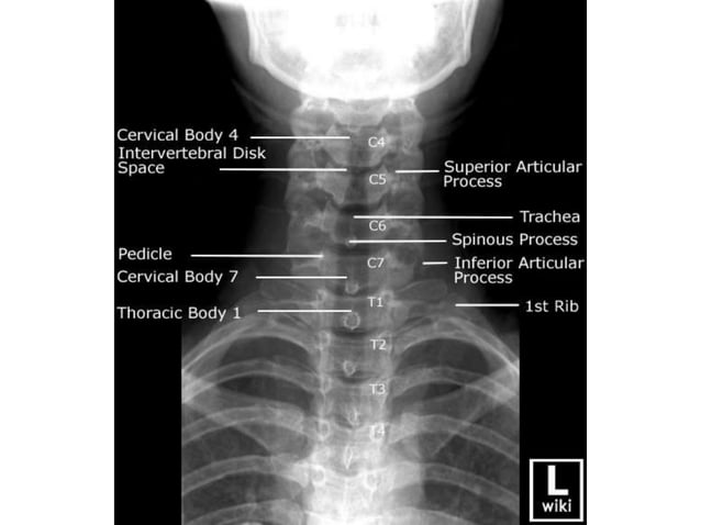 C1 C2 fractures | PPTX