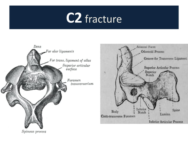 C1 C2 fractures