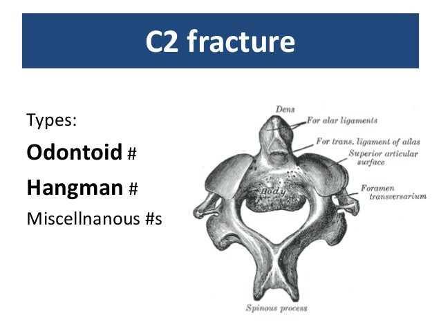 C1 C2 fractures