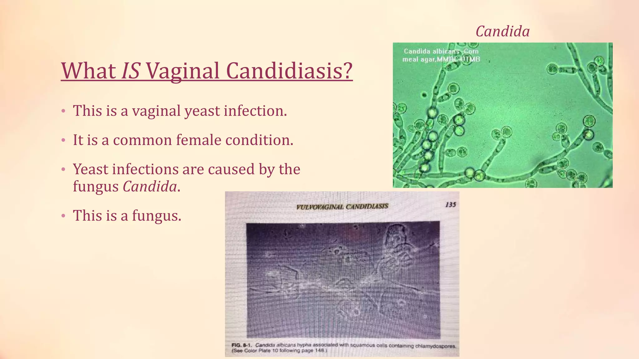 Brandy Goudreau Vaginal Candidiasis | PPTX