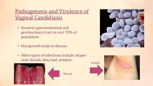 Brandy Goudreau Vaginal Candidiasis