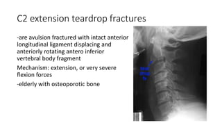 C2 fracture | PPTX
