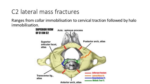 C2 fracture