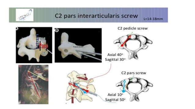 C2 fracture - Dr Sameep Koshti (Consultant Neurosurgeon) | PPT