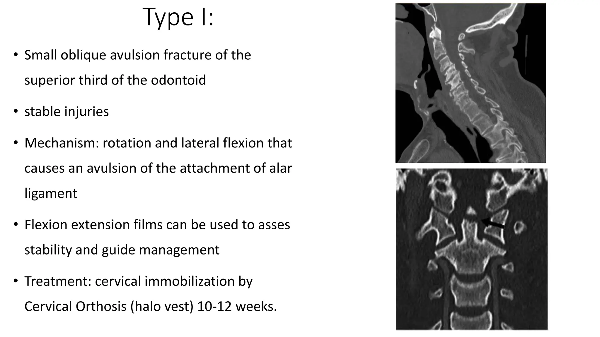 C2 (Axis) cervical Spine Fracture Presentation | PPTX