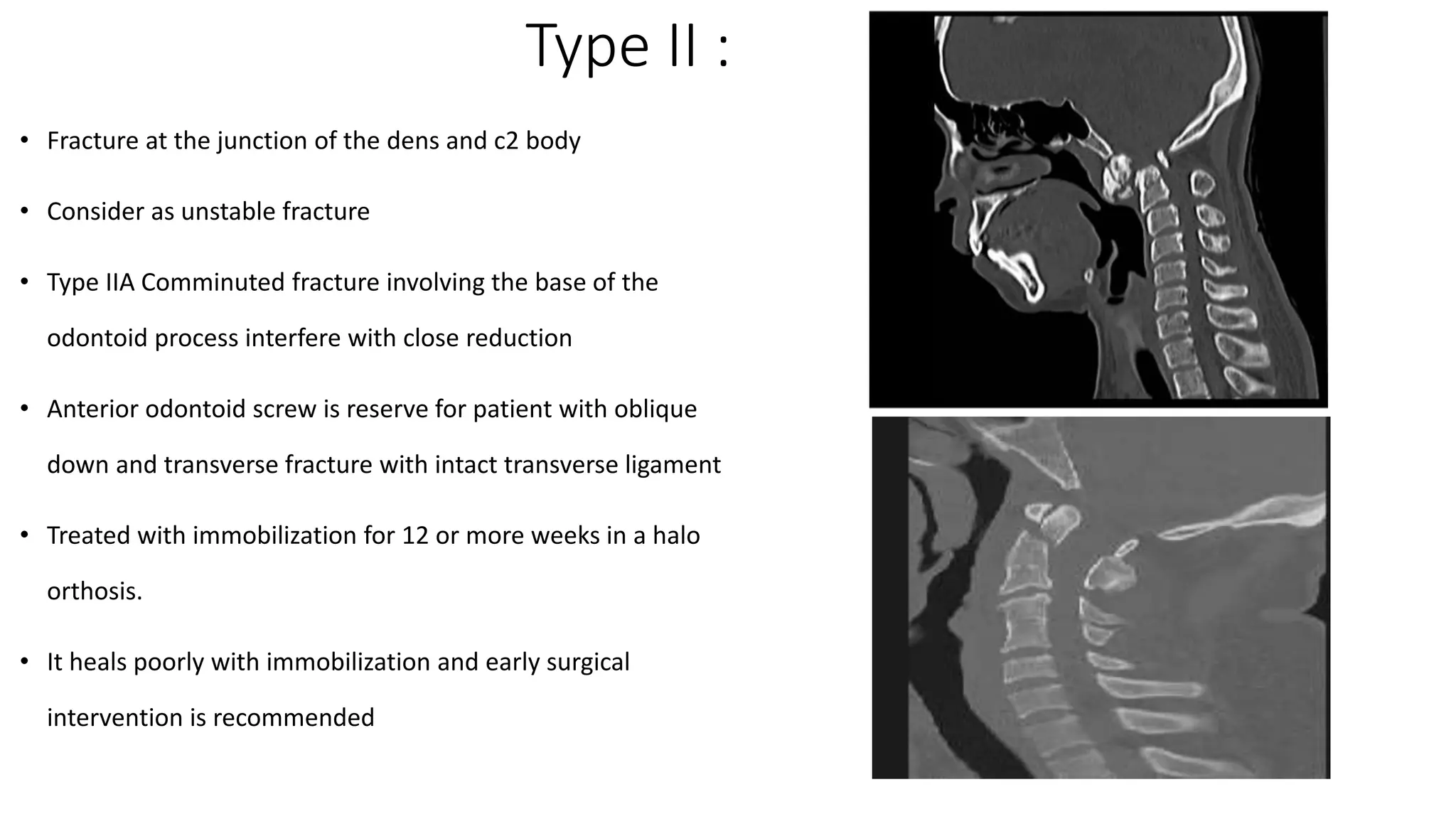 C2 (Axis) cervical Spine Fracture Presentation | PPTX