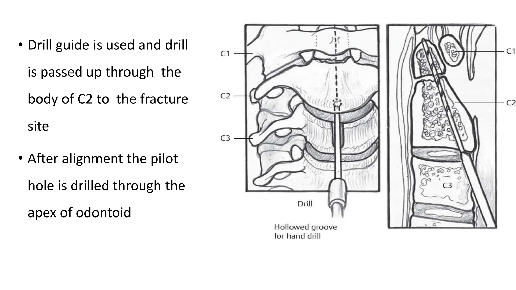 C2 (Axis) cervical Spine Fracture Presentation | PPTX